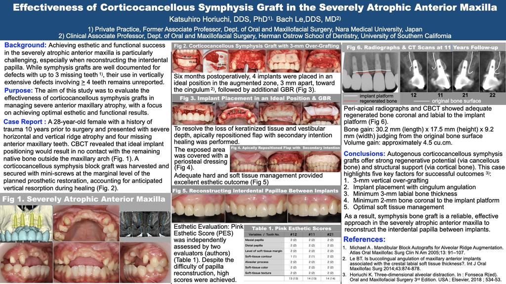 Effectiveness of Corticocancellous Symphysis Graft in the Severely ...